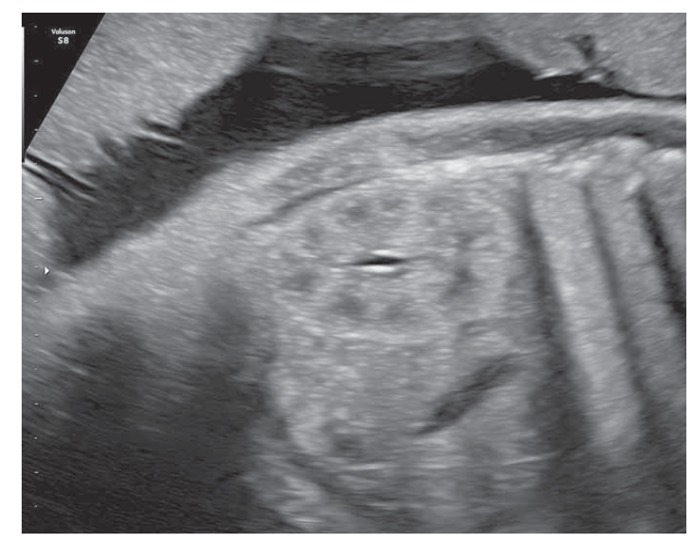 Fetal lower urinary tract obstruction: a curr... | Česká gynekologie
