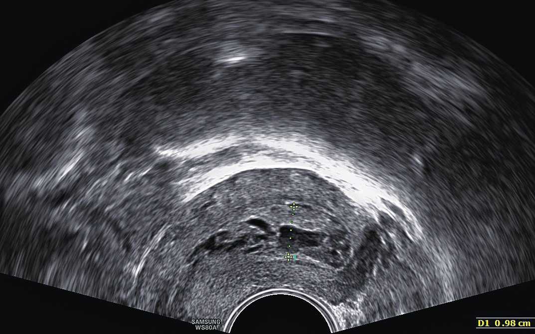 Je nález hyperplazie či polypu děložní dutiny... | Česká gynekologie